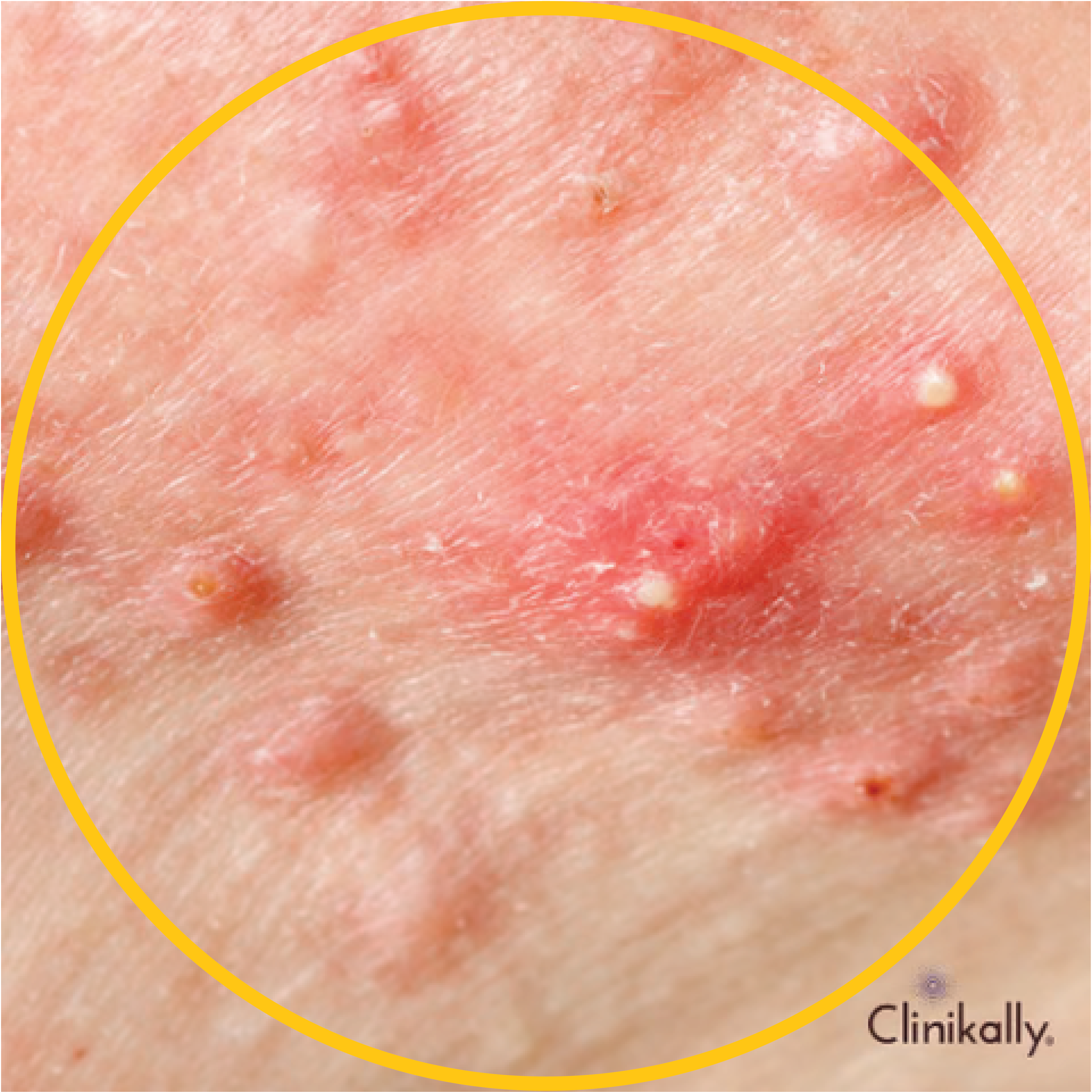 FUNGAL ACNE – Glowin